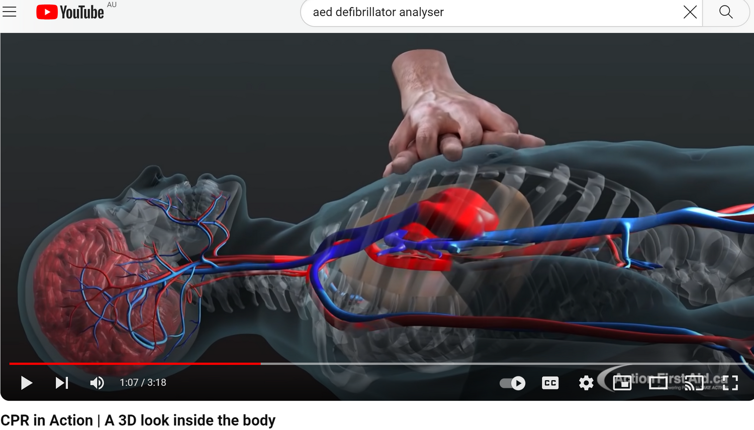 CPR in action, a 3D look inside the body. – Cardiac X